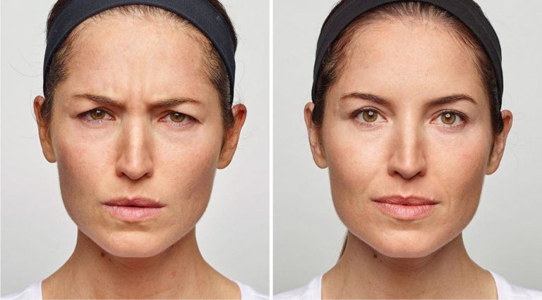 Dysport® Treatment | BeverlyHillsDermatology.com